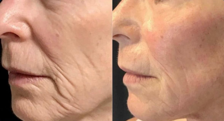 Radio Frequency Micro Needling - The Skin & Body Clinic